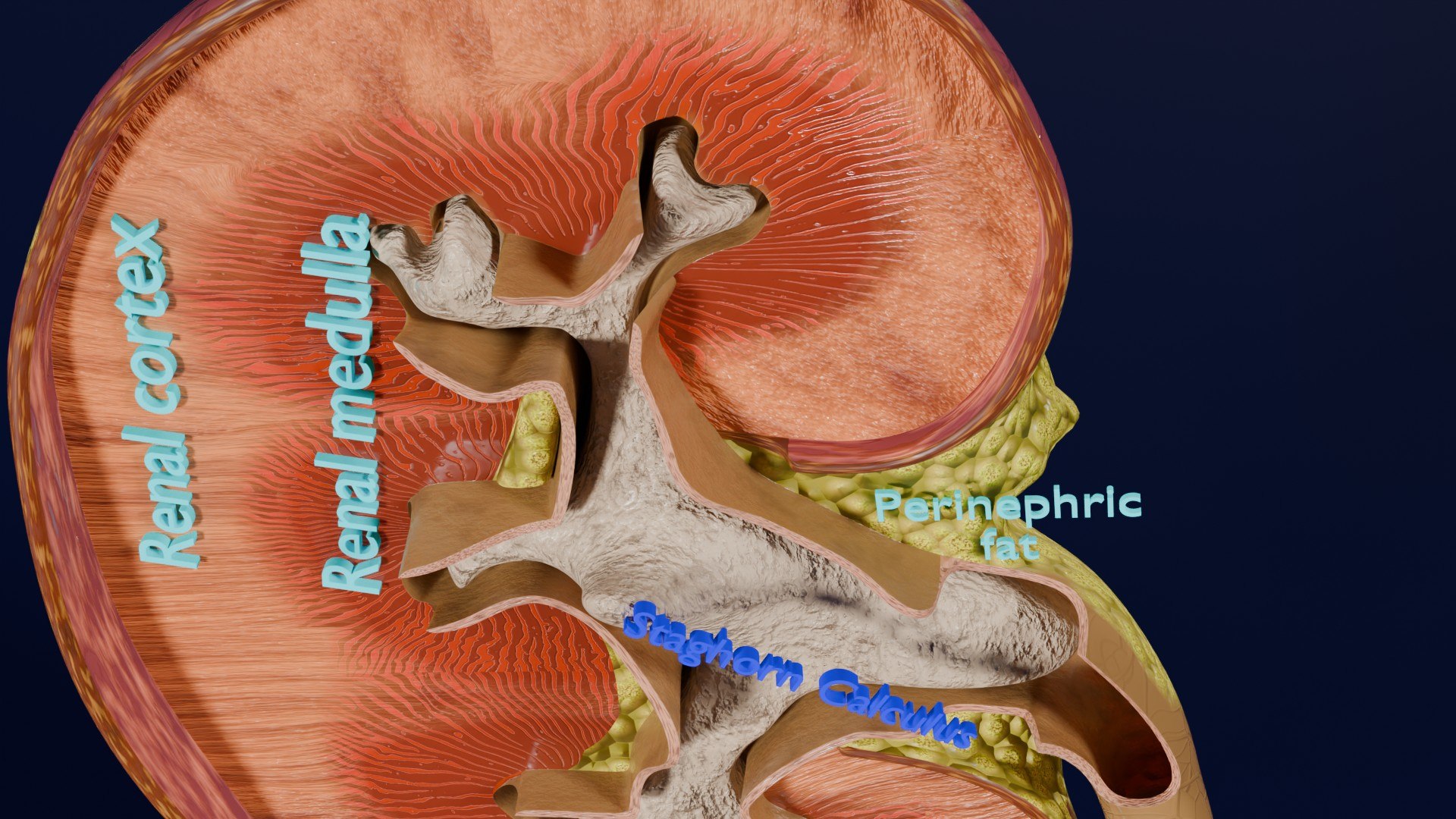 Kidney Stone Nephrolithiasis Staghorn Calculus 3D Model - TurboSquid ...