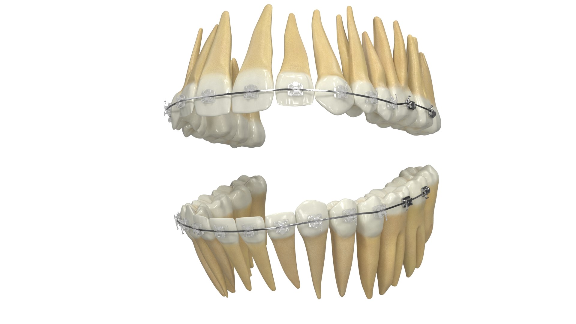 3D Human Teeth With Self Ligating Transparent Dental Braces V01 model ...