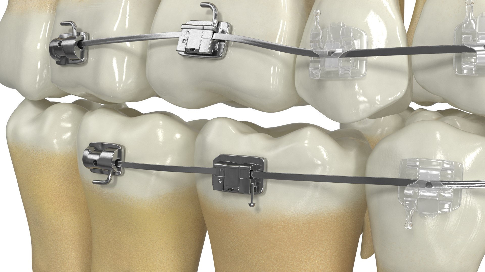 3D Human Teeth With Self Ligating Transparent Dental Braces V01 model ...