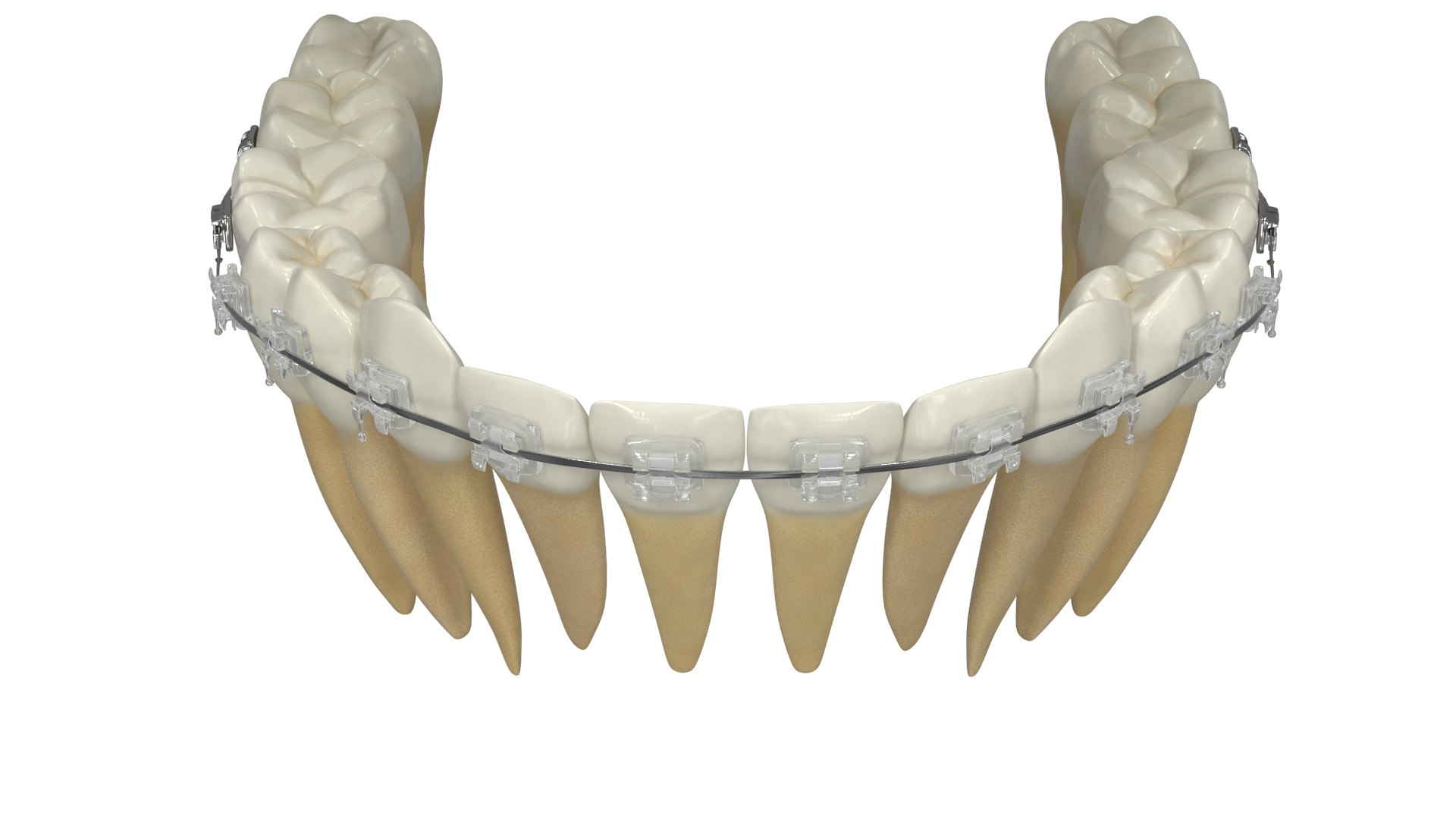 3D Human Teeth With Self Ligating Transparent Dental Braces V01 model ...