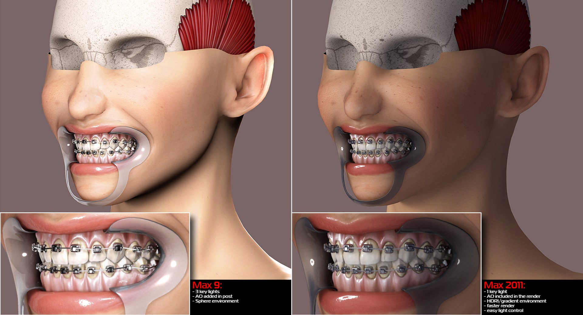 mouth orthodontics dental v4 max