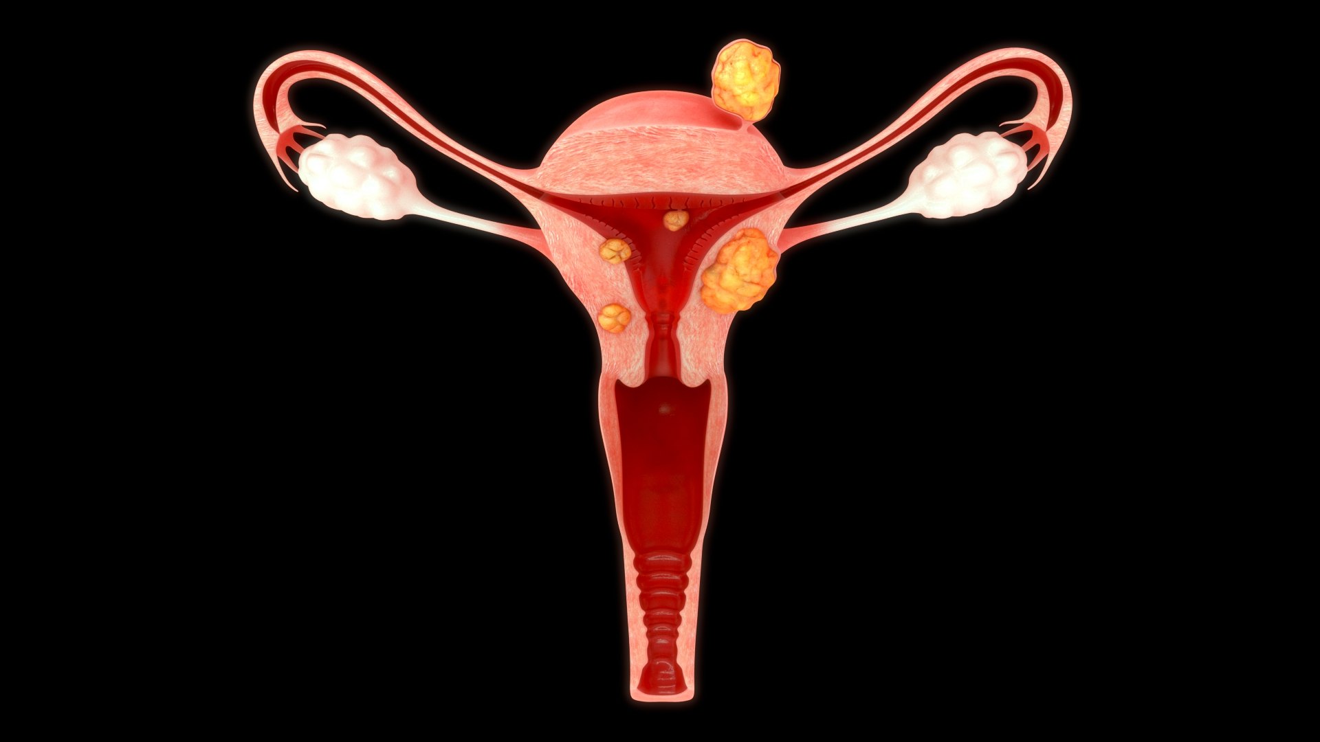 Uterine Fibroids 3D Model - TurboSquid 2309903