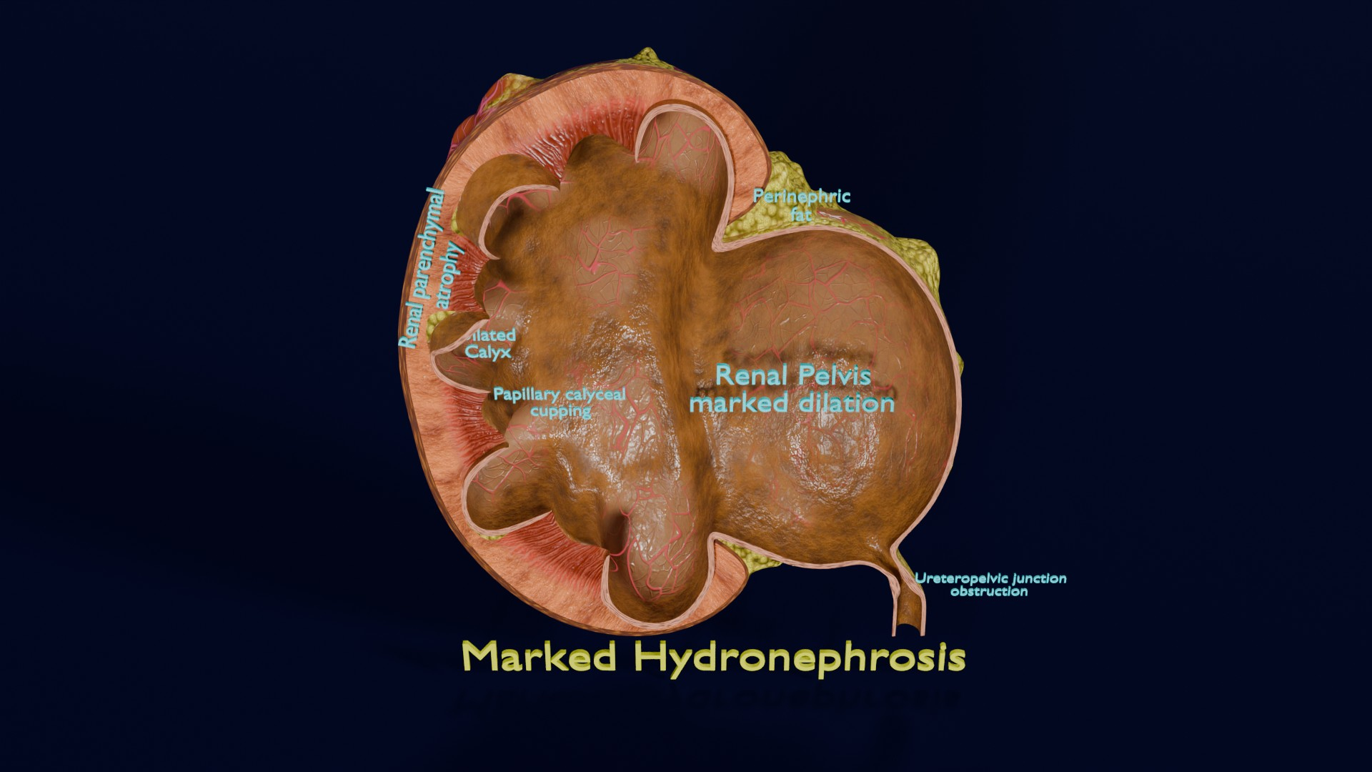 3D Hydronephrosis Marked Kidney Renal Model - TurboSquid 2320712