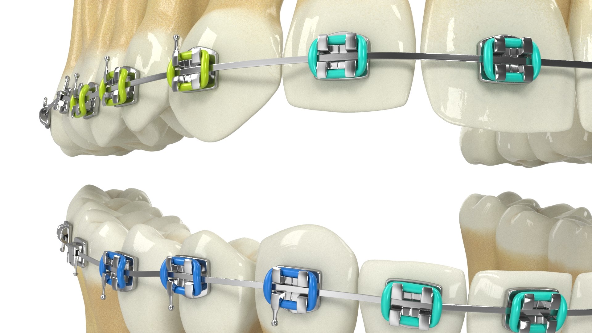 Human Teeth With Steel Dental Braces V04 Model - TurboSquid 2211971