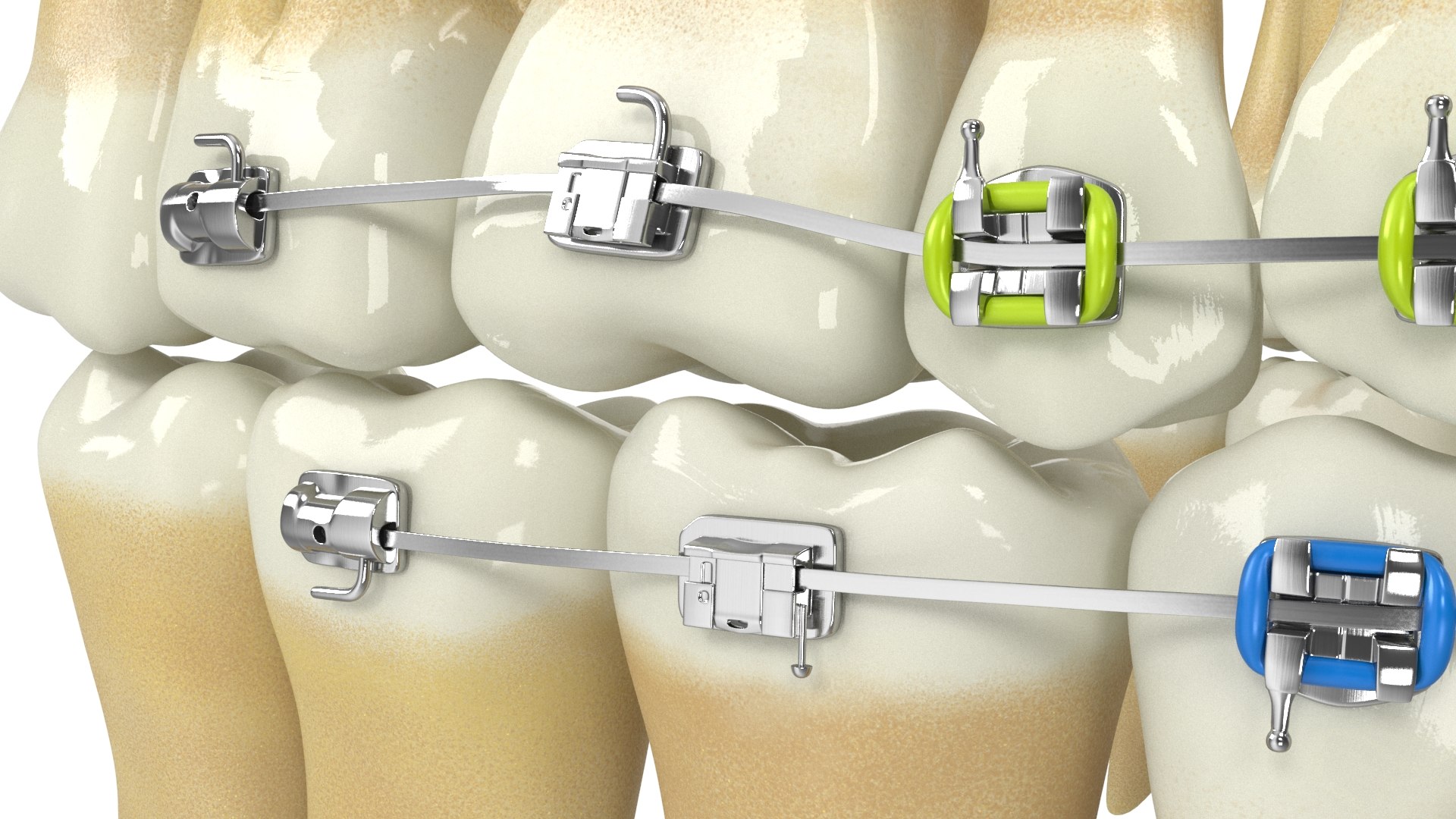 Human Teeth With Steel Dental Braces V04 Model - TurboSquid 2211971