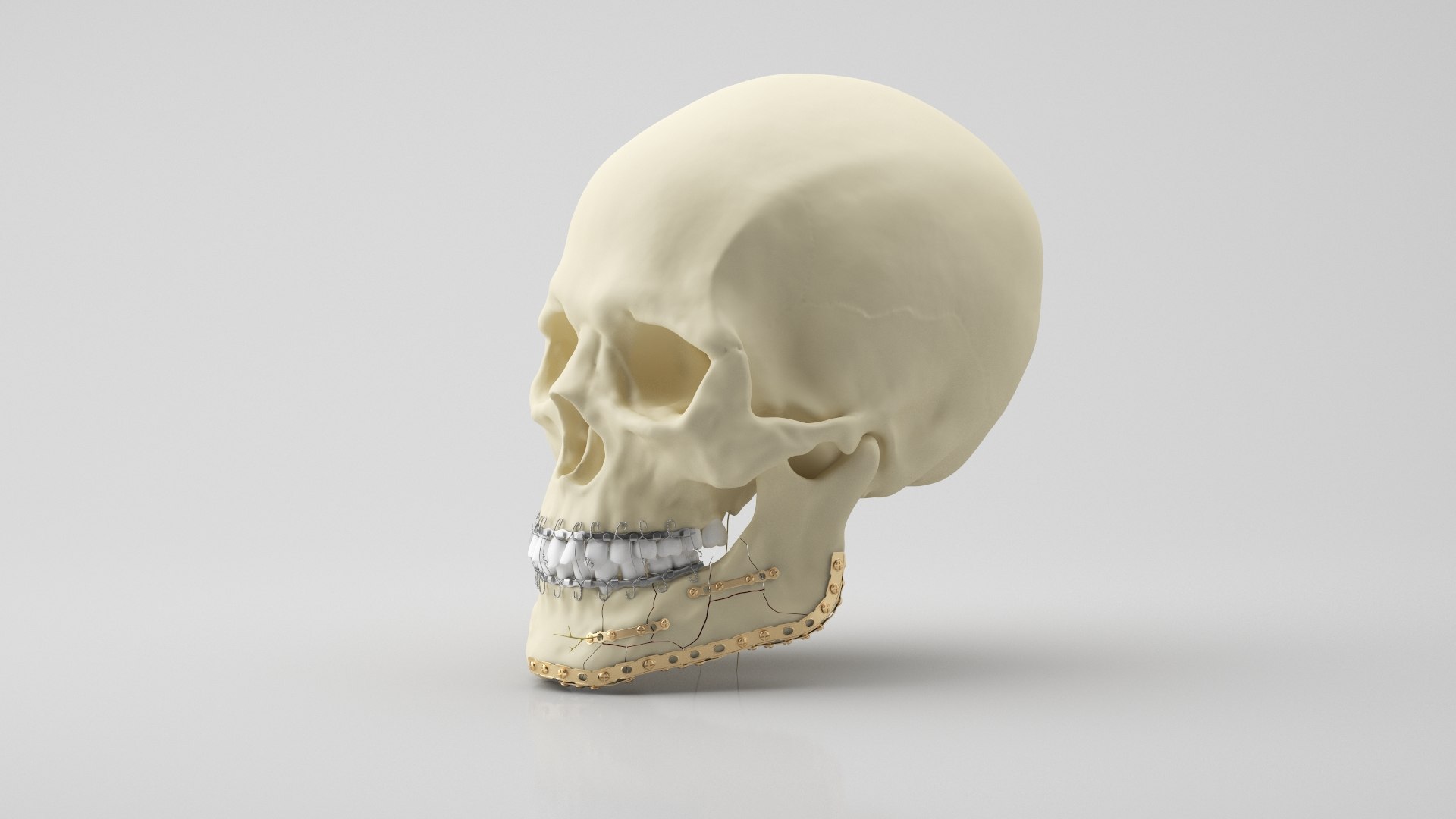 3D Male Skull - Mandible Fracture Model - TurboSquid 2295423
