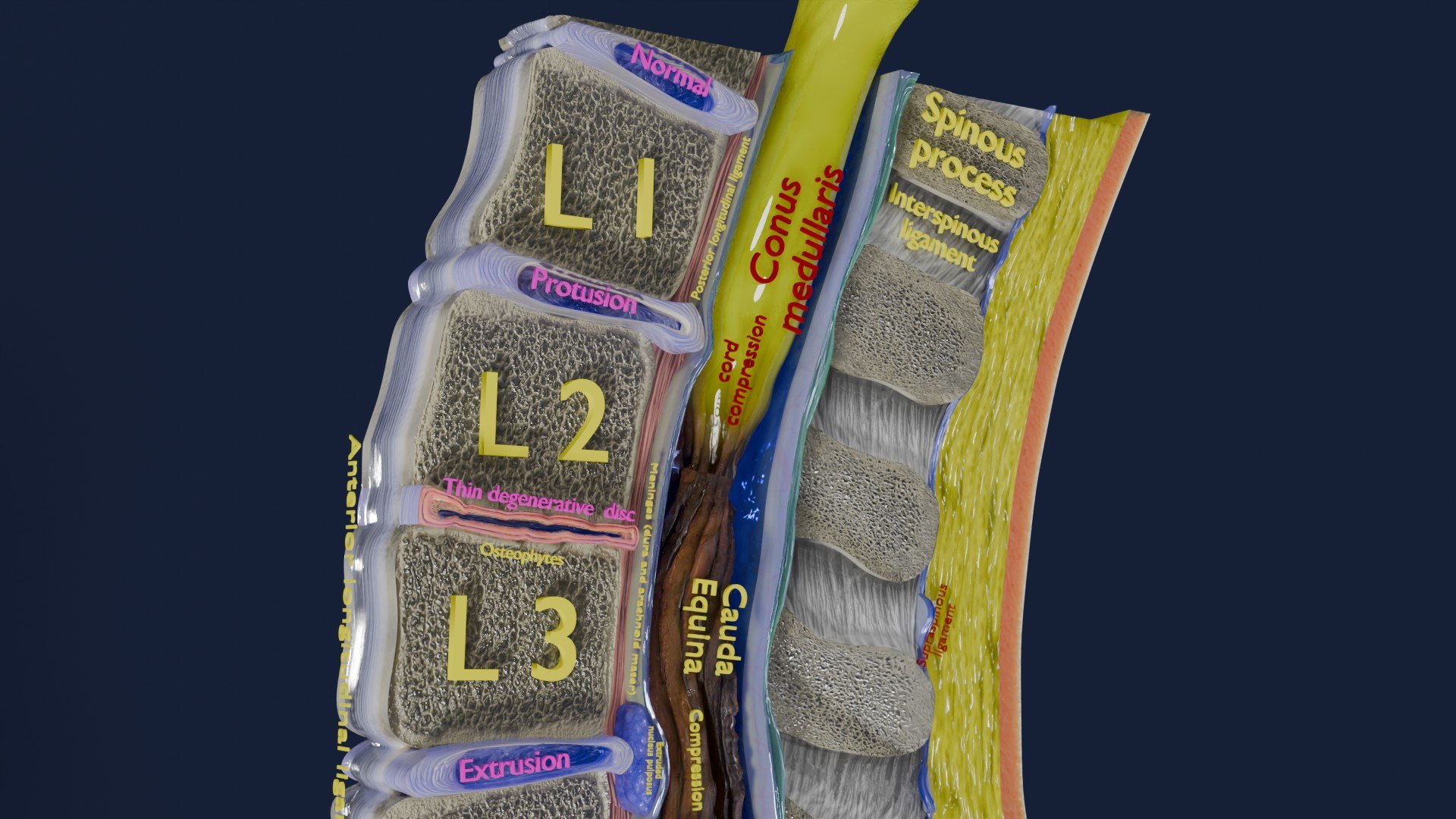 Intervertebral Herniation Slipped Ruptured Disc 3D - TurboSquid 2388428