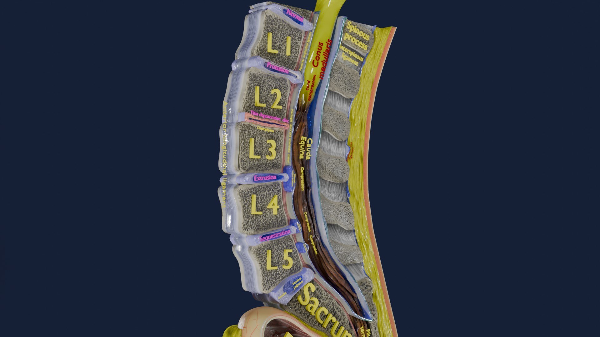 Intervertebral Herniation Slipped Ruptured Disc 3D - TurboSquid 2388428