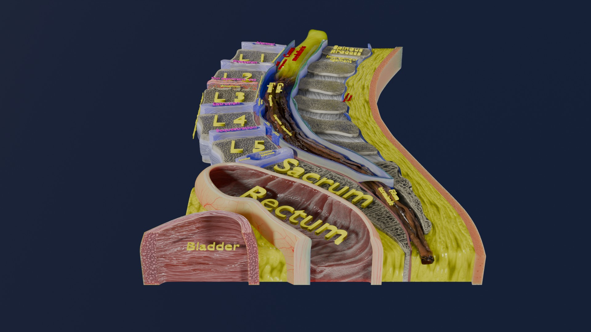 Intervertebral Herniation Slipped Ruptured Disc 3D - TurboSquid 2388428
