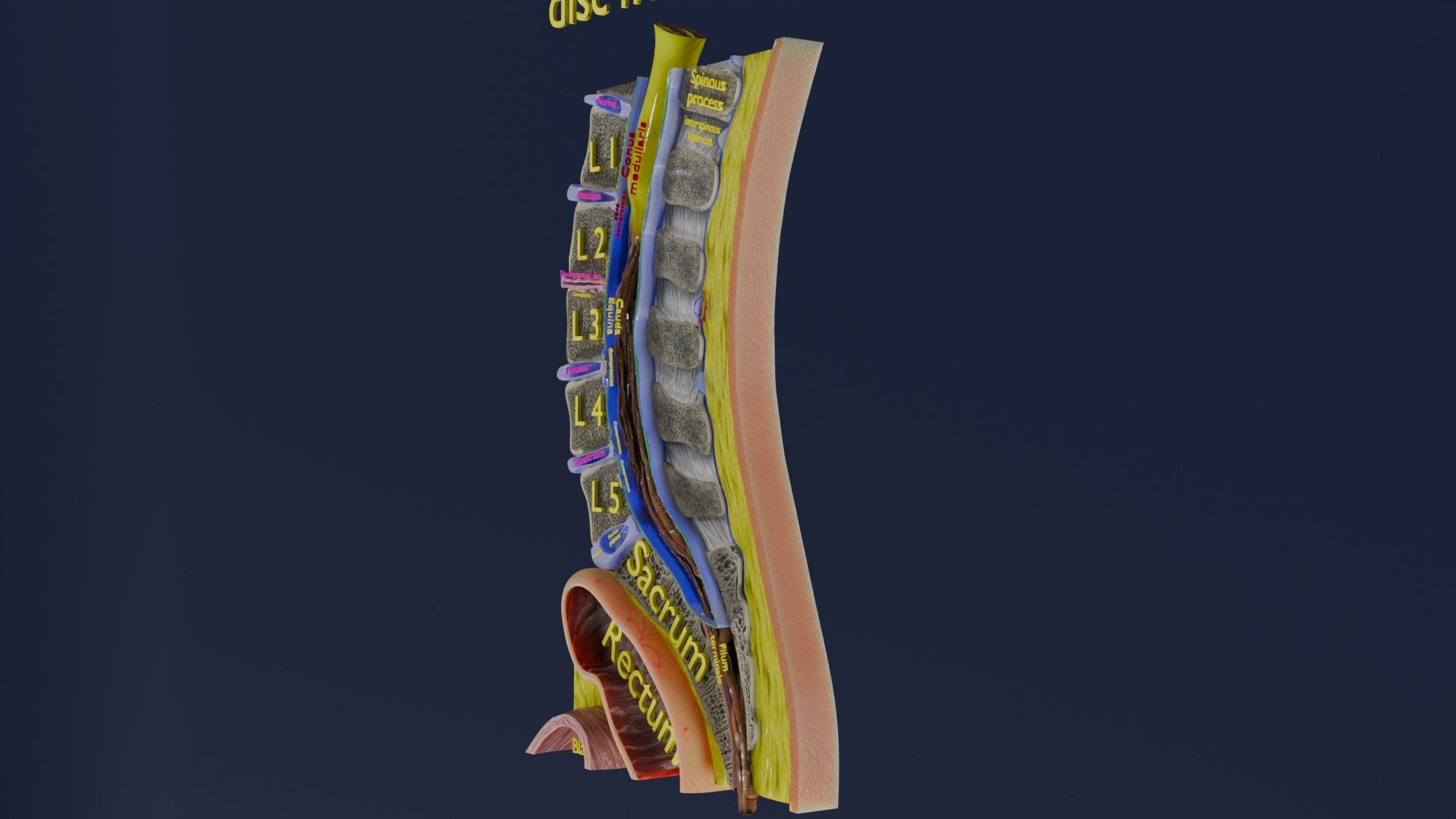 Intervertebral Herniation Slipped Ruptured Disc 3D - TurboSquid 2388428