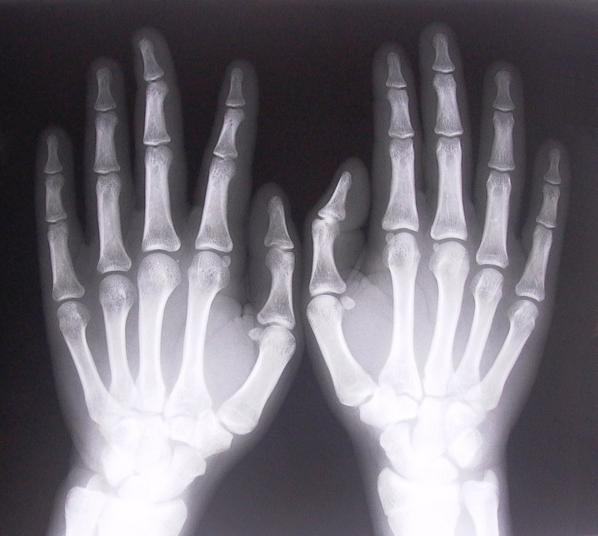 Xray Hand Human Bones 3D - TurboSquid 1278530