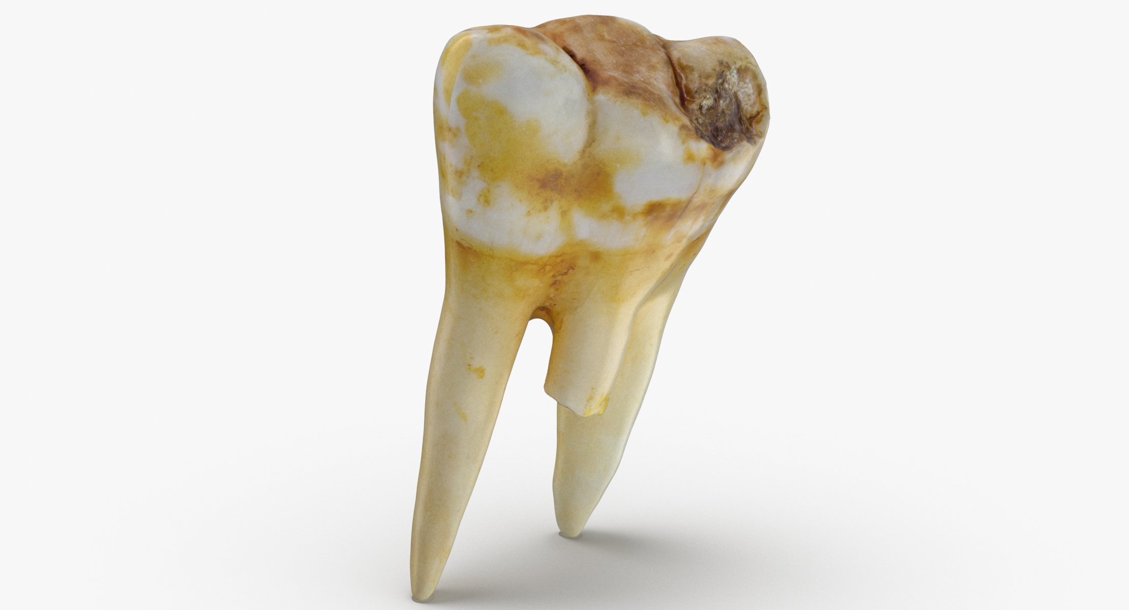 Human Teeth with Cavity Collection - 3 models 3D model - TurboSquid 1753818