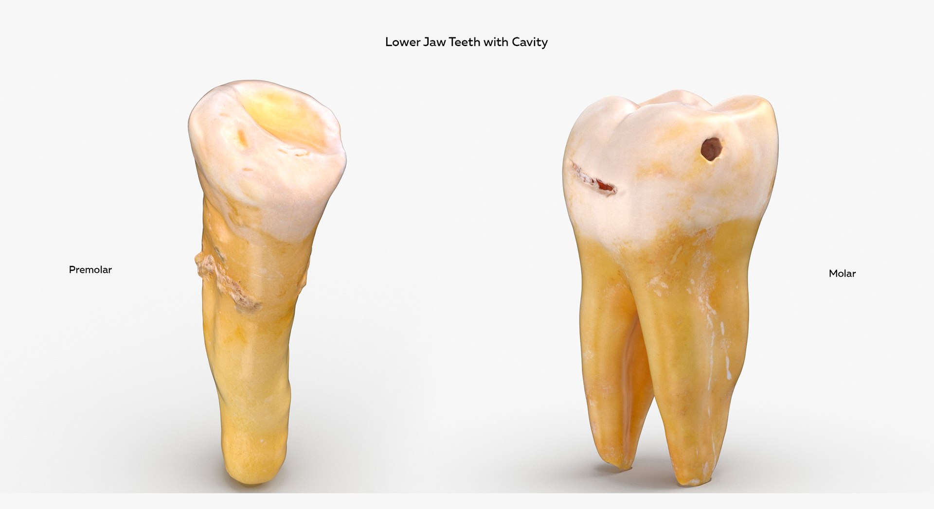 Human Teeth with Cavity Collection - 3 models 3D model - TurboSquid 1753818
