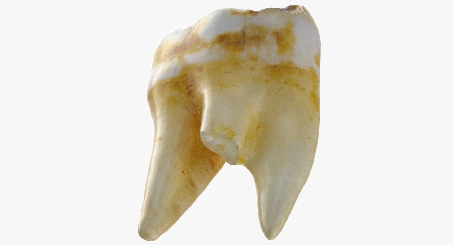 Human Teeth with Cavity Collection - 3 models 3D model - TurboSquid 1753818