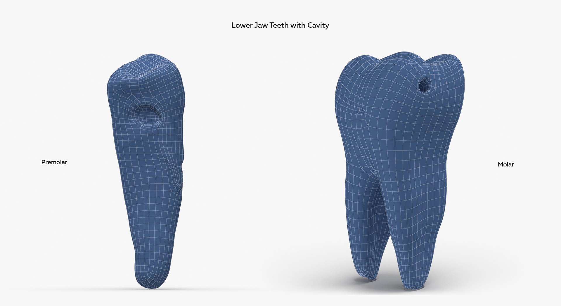 Human Teeth with Cavity Collection - 3 models 3D model - TurboSquid 1753818