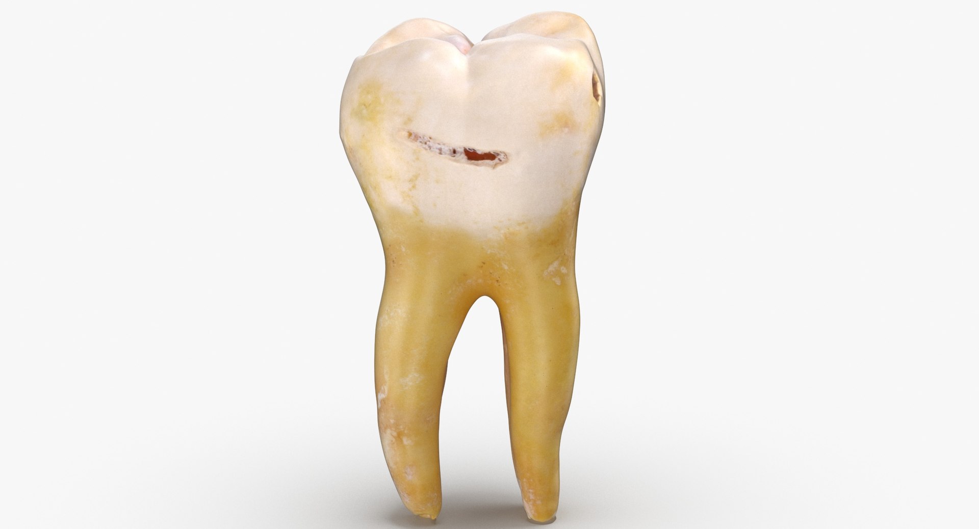 Human Teeth with Cavity Collection - 3 models 3D model - TurboSquid 1753818