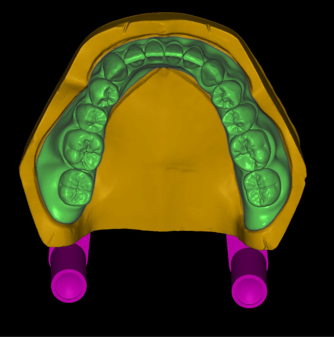 Free Full Denture Set - Upper And Lower Anatomy STL 3D Model ...