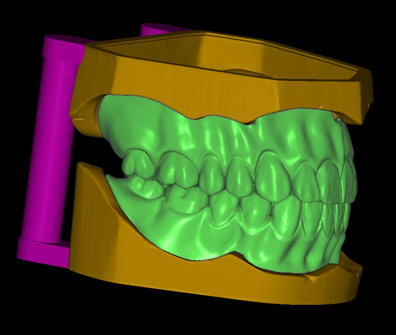 Free Full Denture Set - Upper And Lower Anatomy STL 3D Model ...