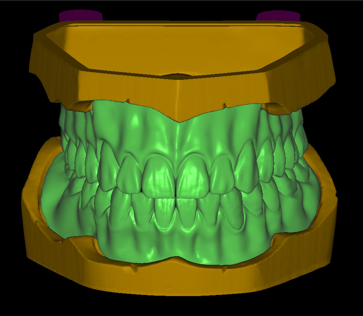 Free Full Denture Set - Upper And Lower Anatomy STL 3D Model ...