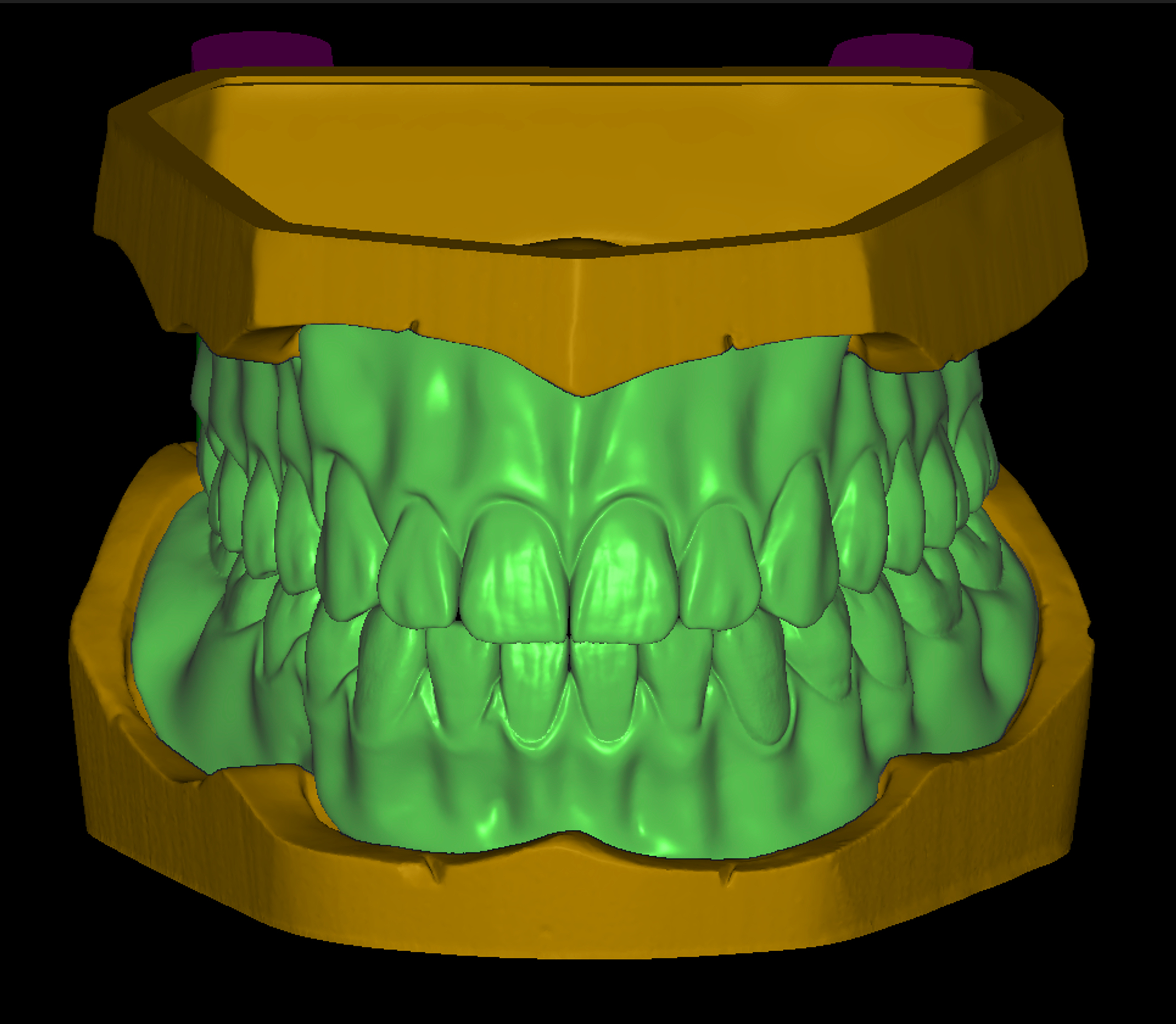 modelo 3d Juego completo de prótesis dentales - Anatomía superior e ...