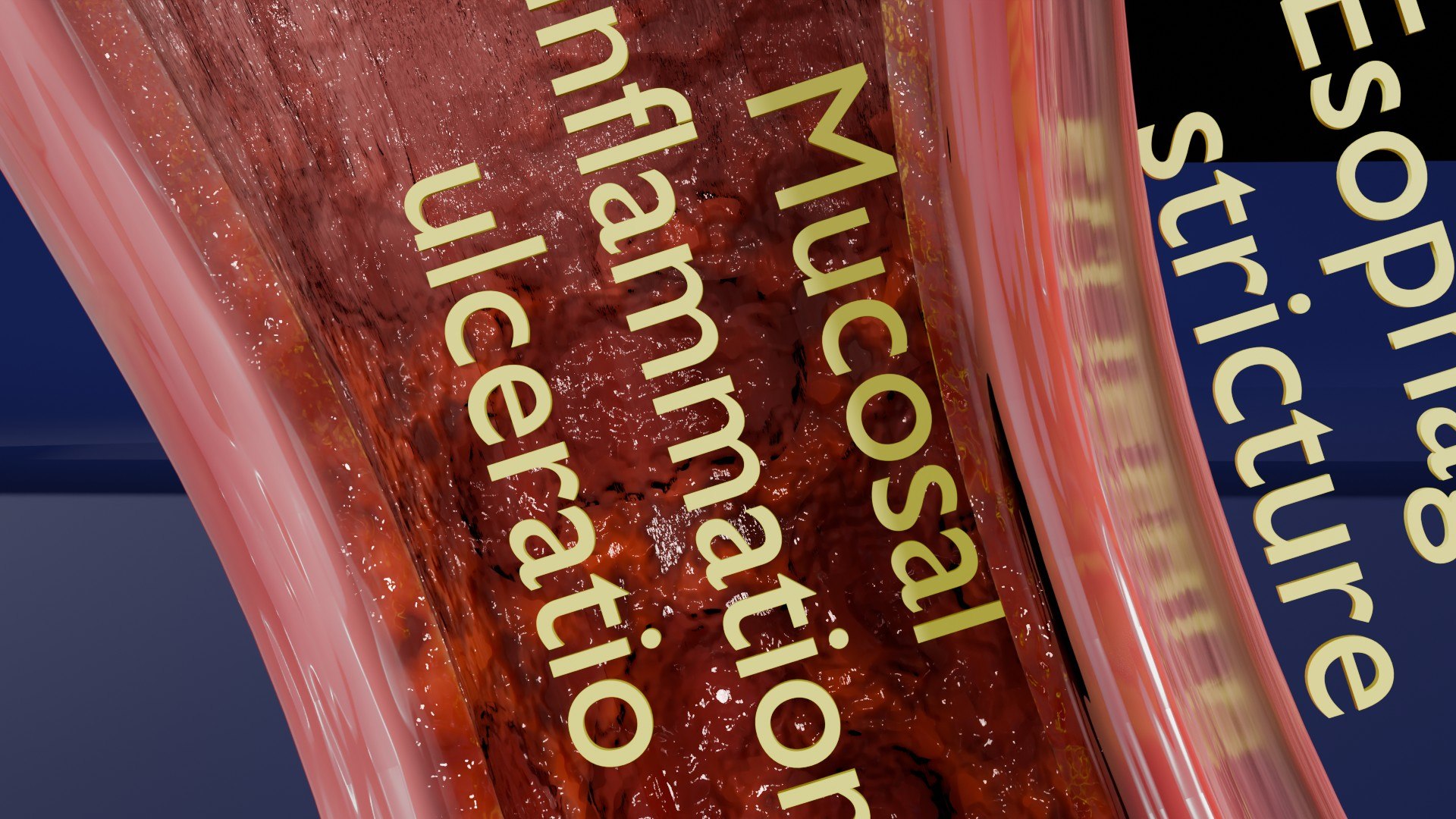 Gastro Oesophageal Reflux Disease 3D Model - TurboSquid 2421235