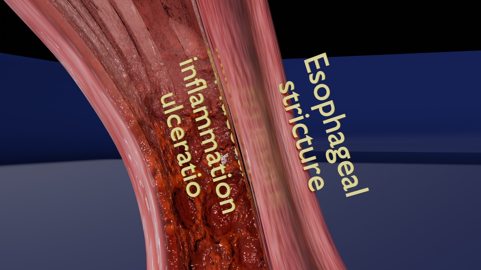 Gastro Oesophageal Reflux Disease 3D Model - TurboSquid 2421235