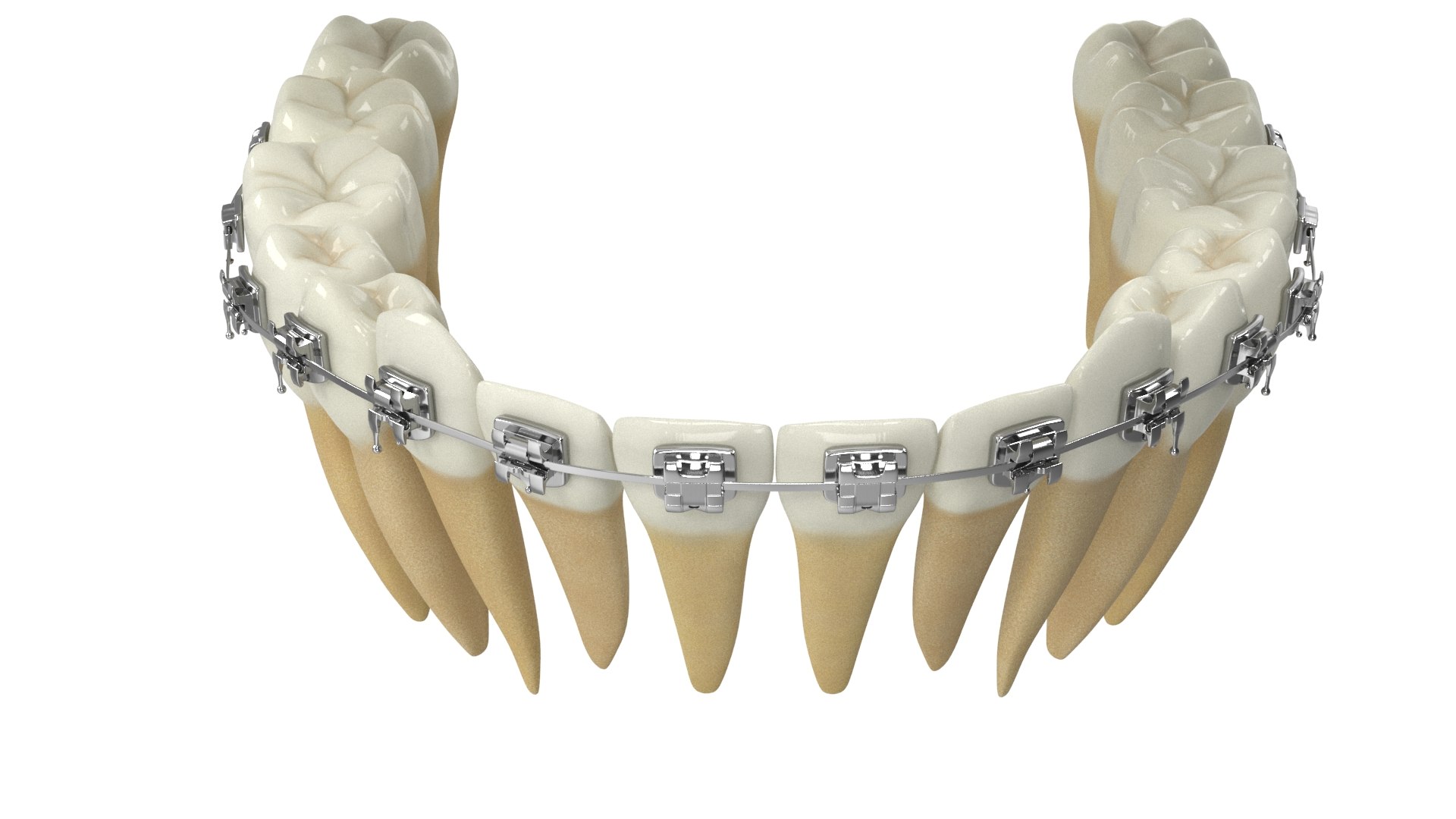 3D Human Teeth With Self Ligating Steel Dental Braces V03 - TurboSquid ...