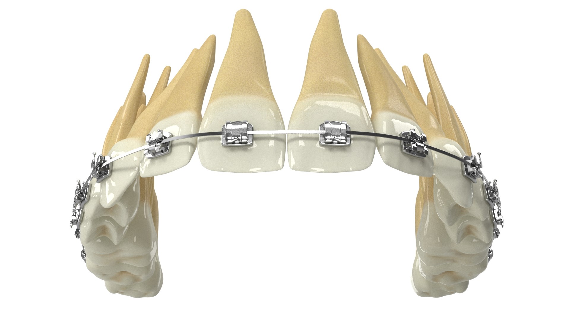 3D Human Teeth With Self Ligating Steel Dental Braces V03 - TurboSquid ...