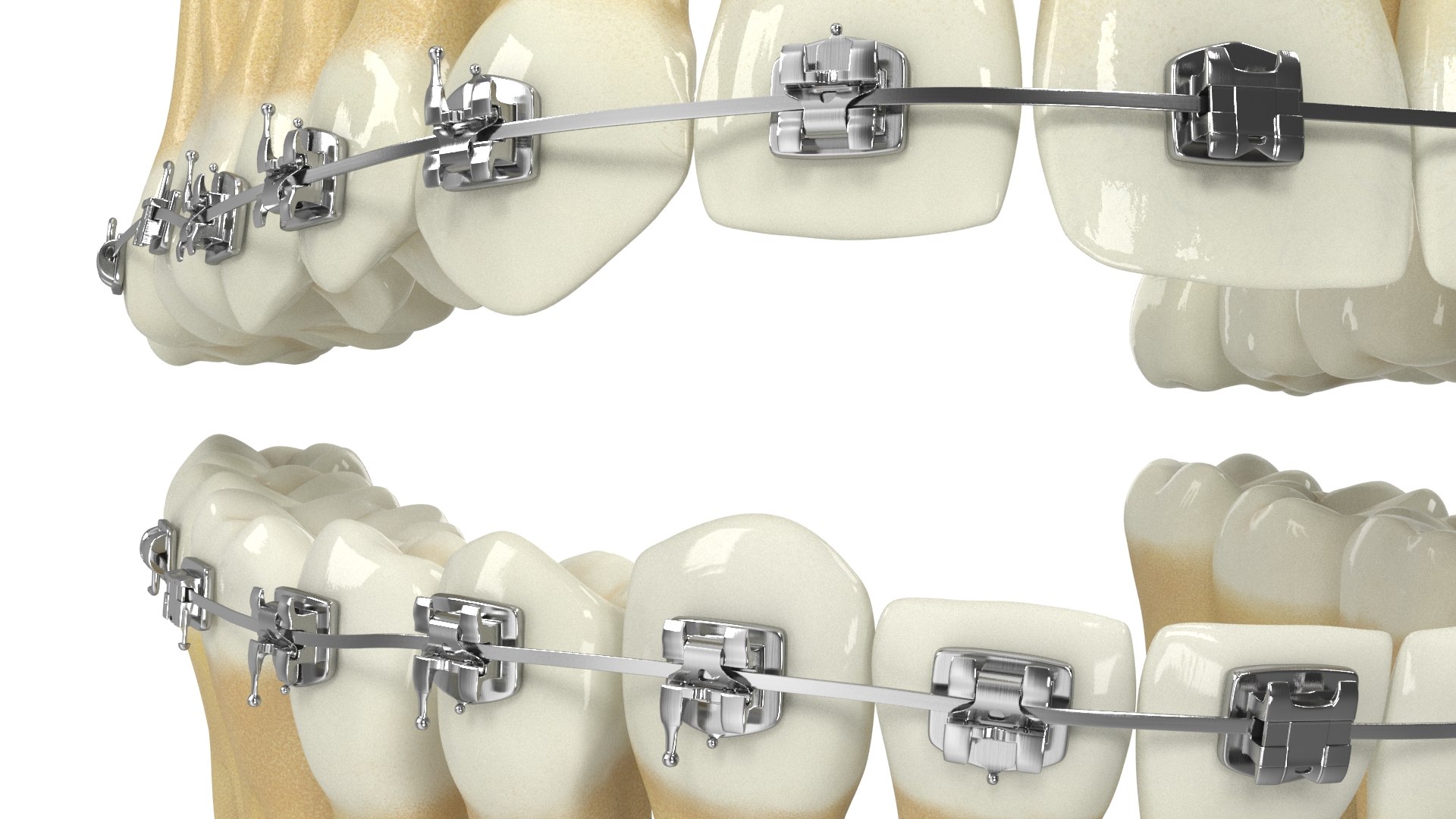 3D Human Teeth With Self Ligating Steel Dental Braces V03 - TurboSquid ...
