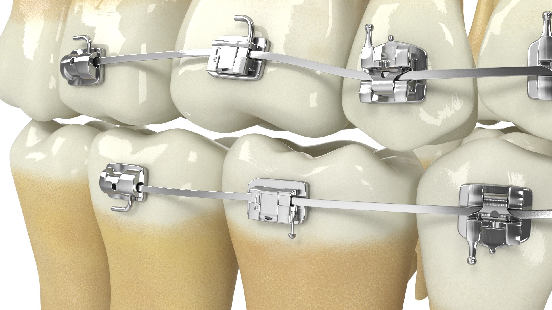 3D Human Teeth With Self Ligating Steel Dental Braces V03 - TurboSquid ...
