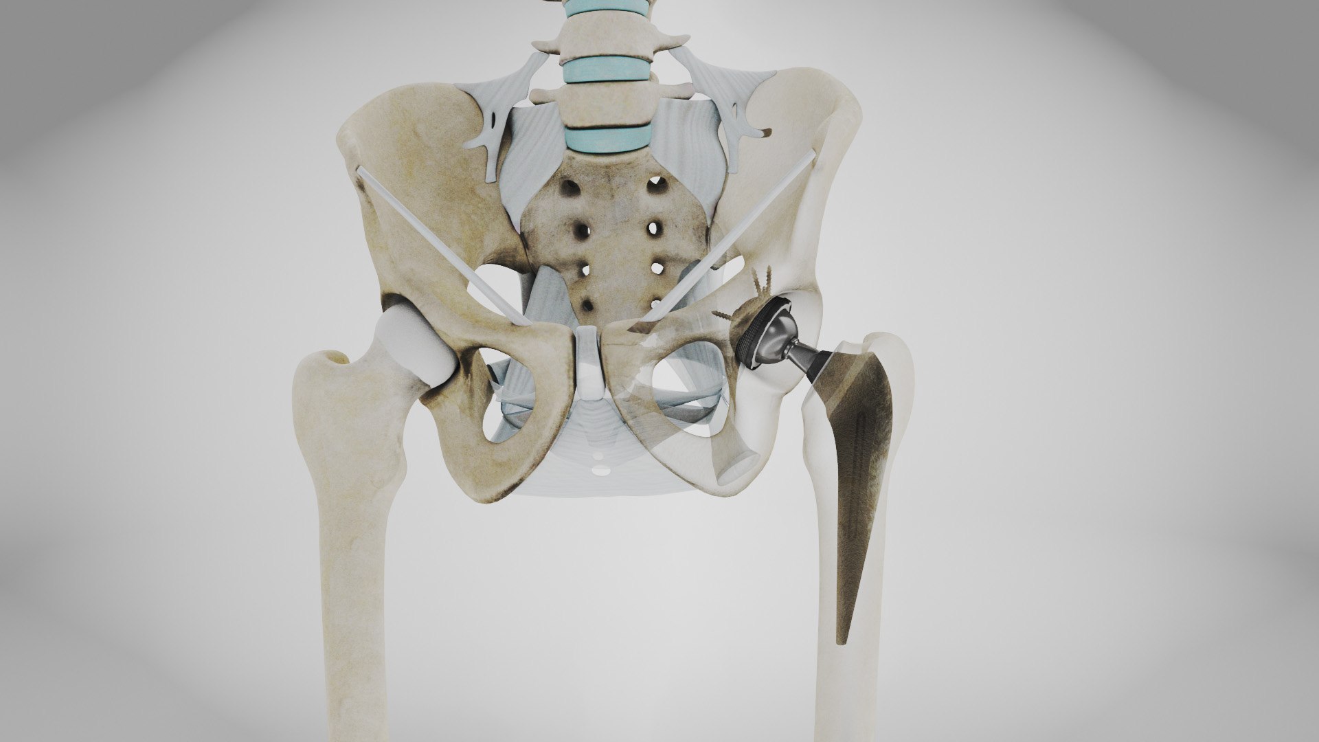 3D Replaced Hip Implant - TurboSquid 2133498