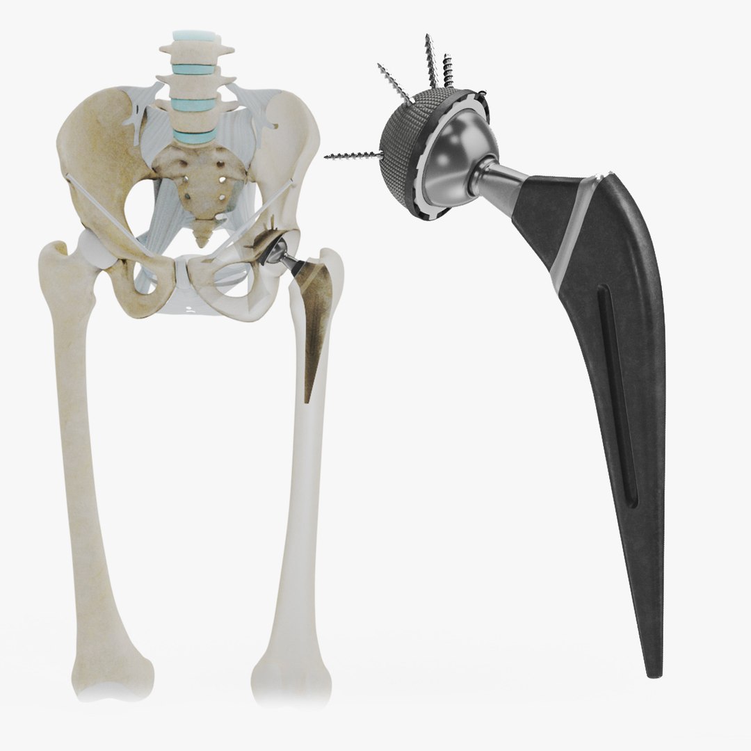 3D Replaced Hip Implant - TurboSquid 2133498