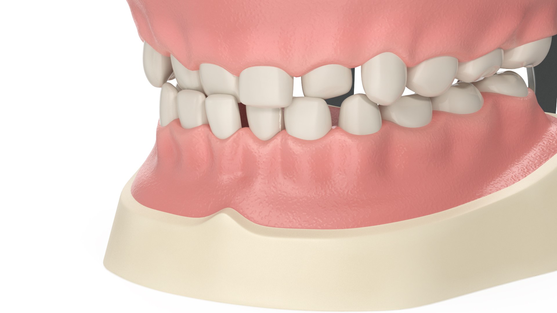 3D Dental Anatomy Model Simulation With Removable Crossbite Teeth ...