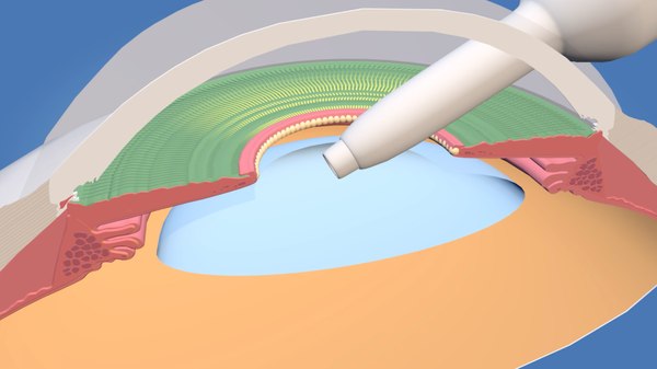 Eye cataract surgery lens model - TurboSquid 1196467