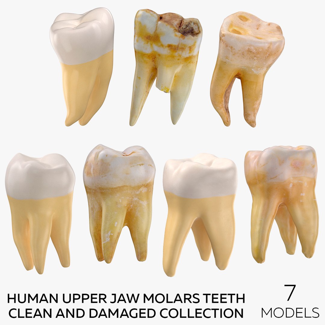 3D Human Upper Jaw Molars Teeth Clean and Damaged Collection - 7 models ...