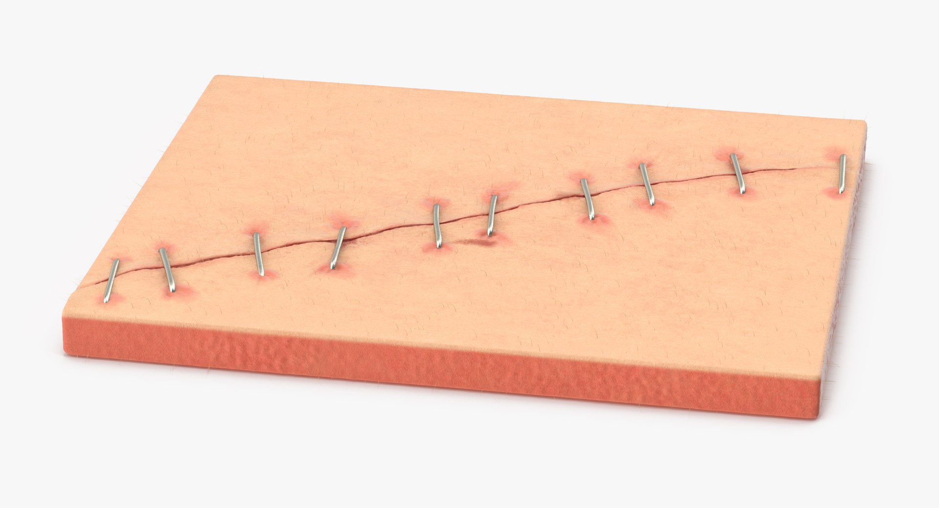 3d Staples Sutures