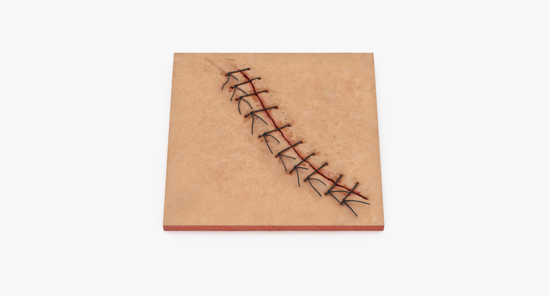 3d Staples Sutures
