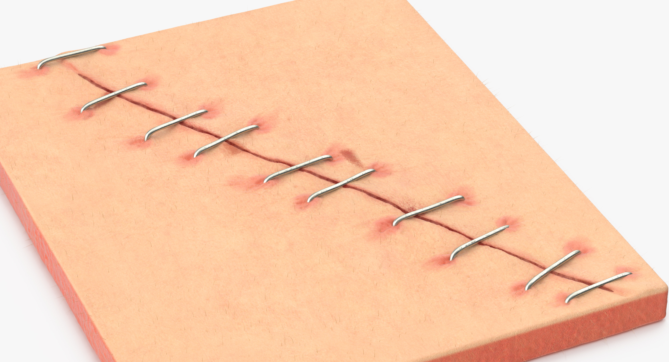 3d staples sutures