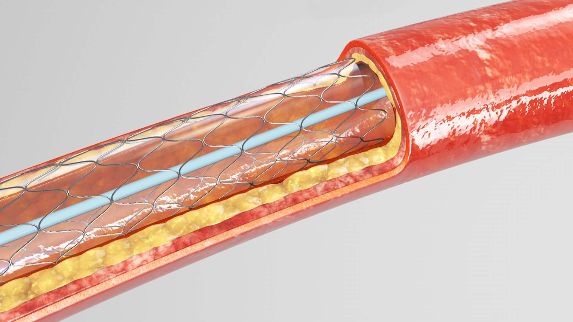 3D Model Blood Stent - TurboSquid 1312675