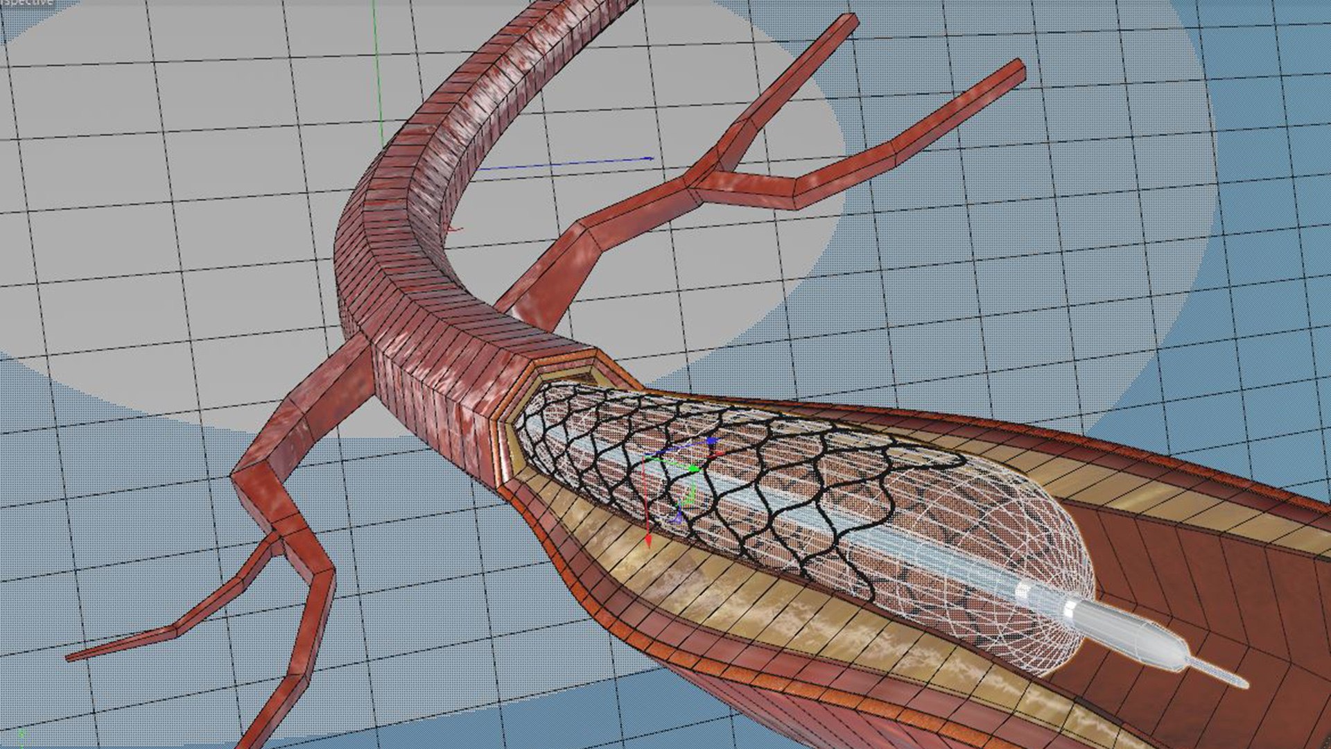 3D Model Blood Stent - TurboSquid 1312675