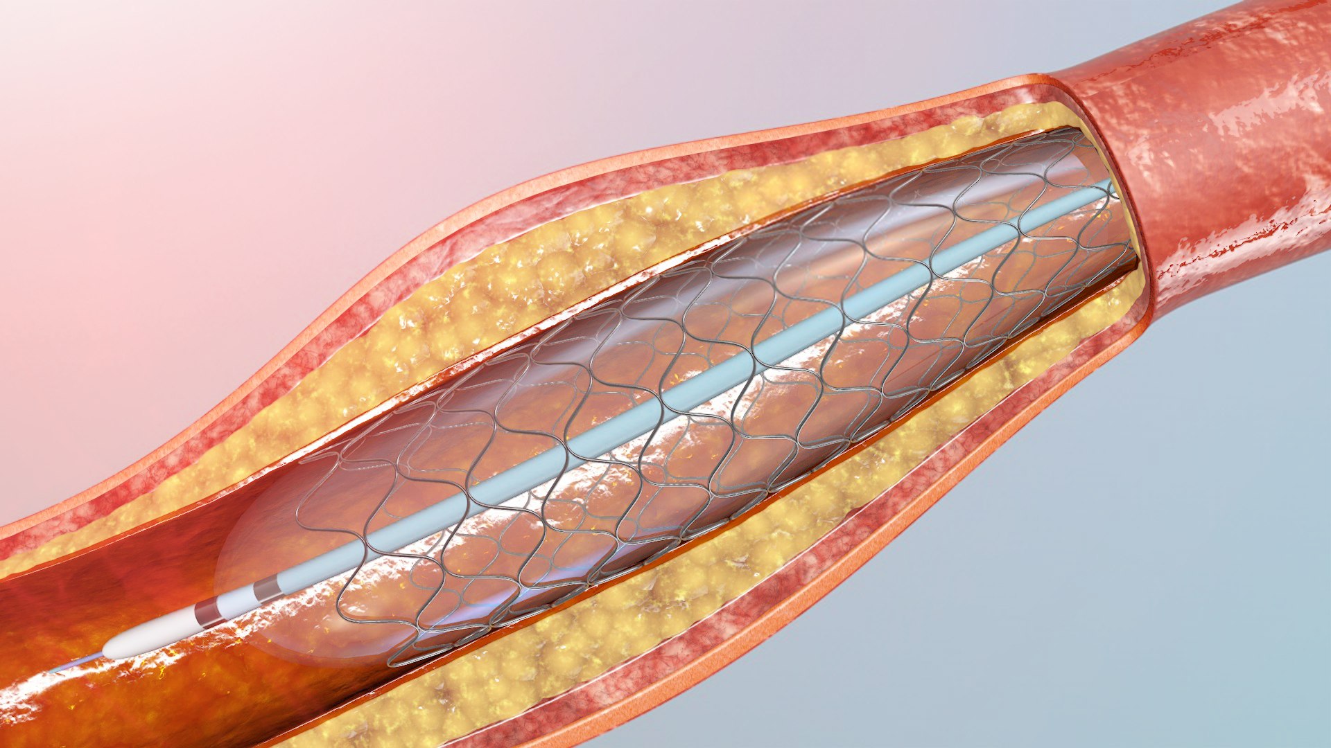 3D Model Blood Stent - TurboSquid 1312675