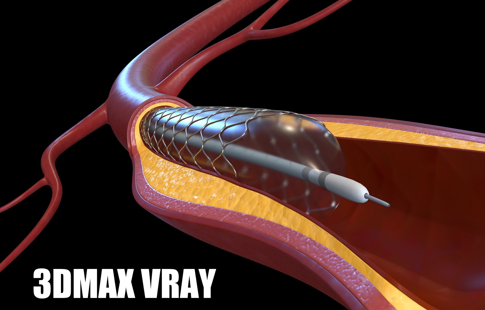 3D Model Blood Stent - TurboSquid 1312675