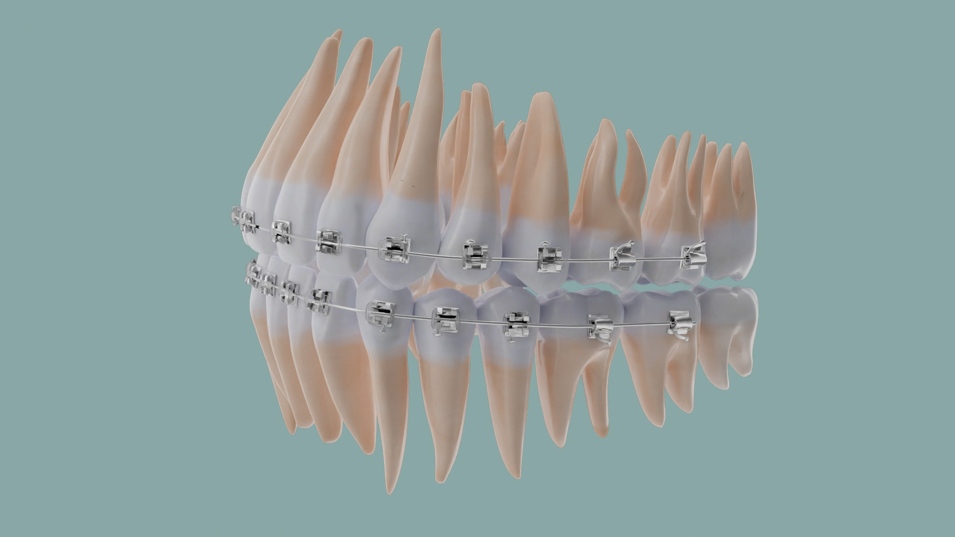 Braces Orthodontics 3D Model - TurboSquid 1567260