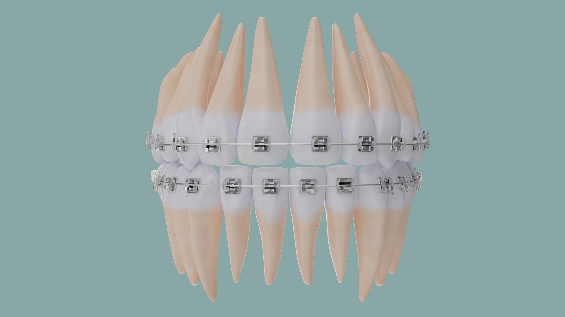 Braces Orthodontics 3D Model - TurboSquid 1567260