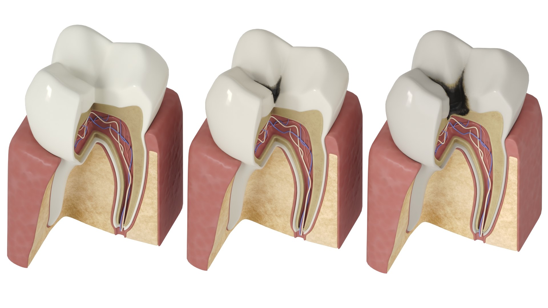 Tooth Decay Stages Cavity Caries 3D Model - TurboSquid 1887620