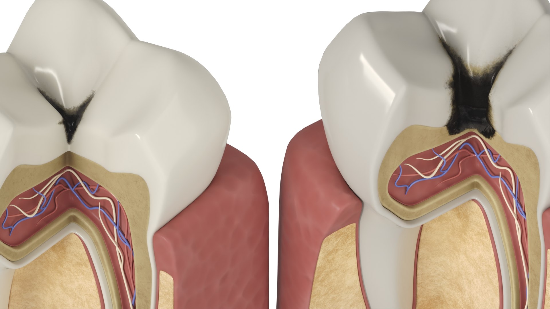 Tooth Decay Stages Cavity Caries 3D Model - TurboSquid 1887620