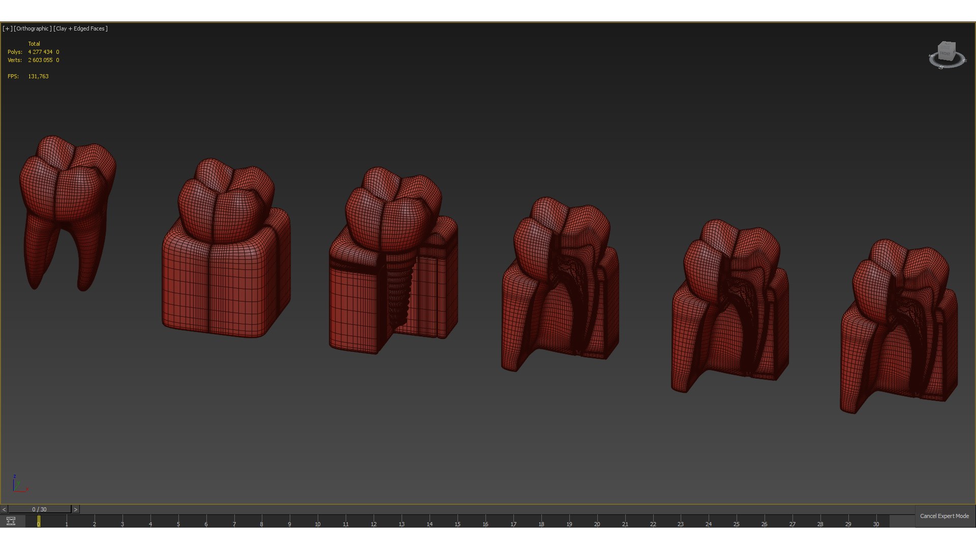 Tooth Decay Stages Cavity Caries 3D Model - TurboSquid 1887620