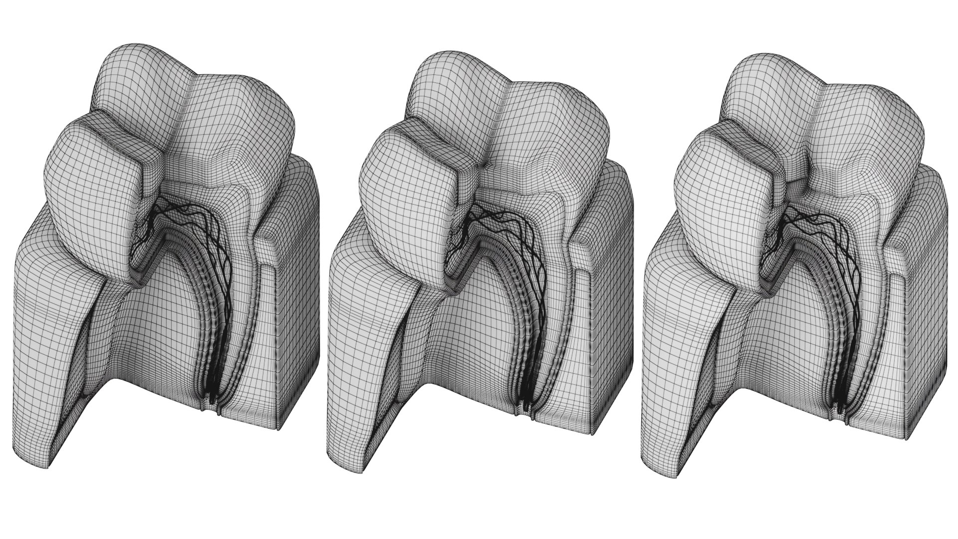 Tooth Decay Stages Cavity Caries 3D Model - TurboSquid 1887620