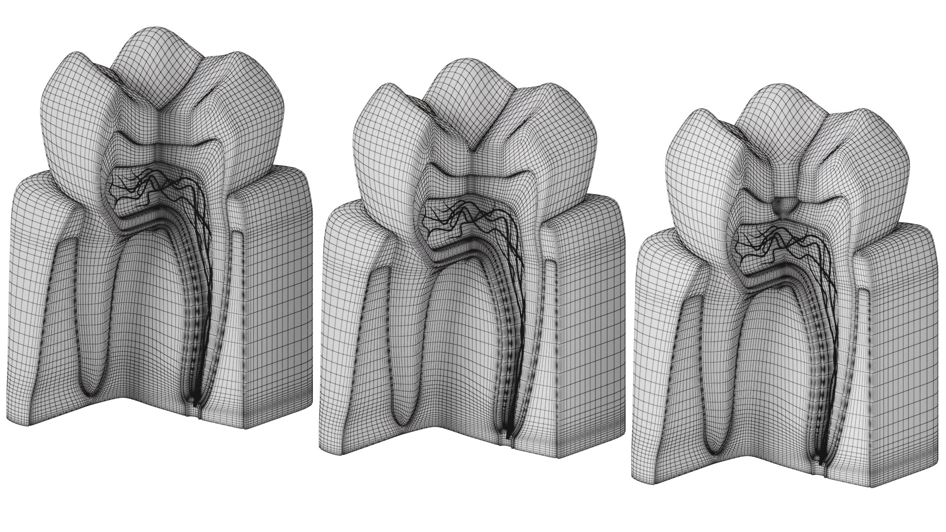 Tooth Decay Stages Cavity Caries 3D Model - TurboSquid 1887620