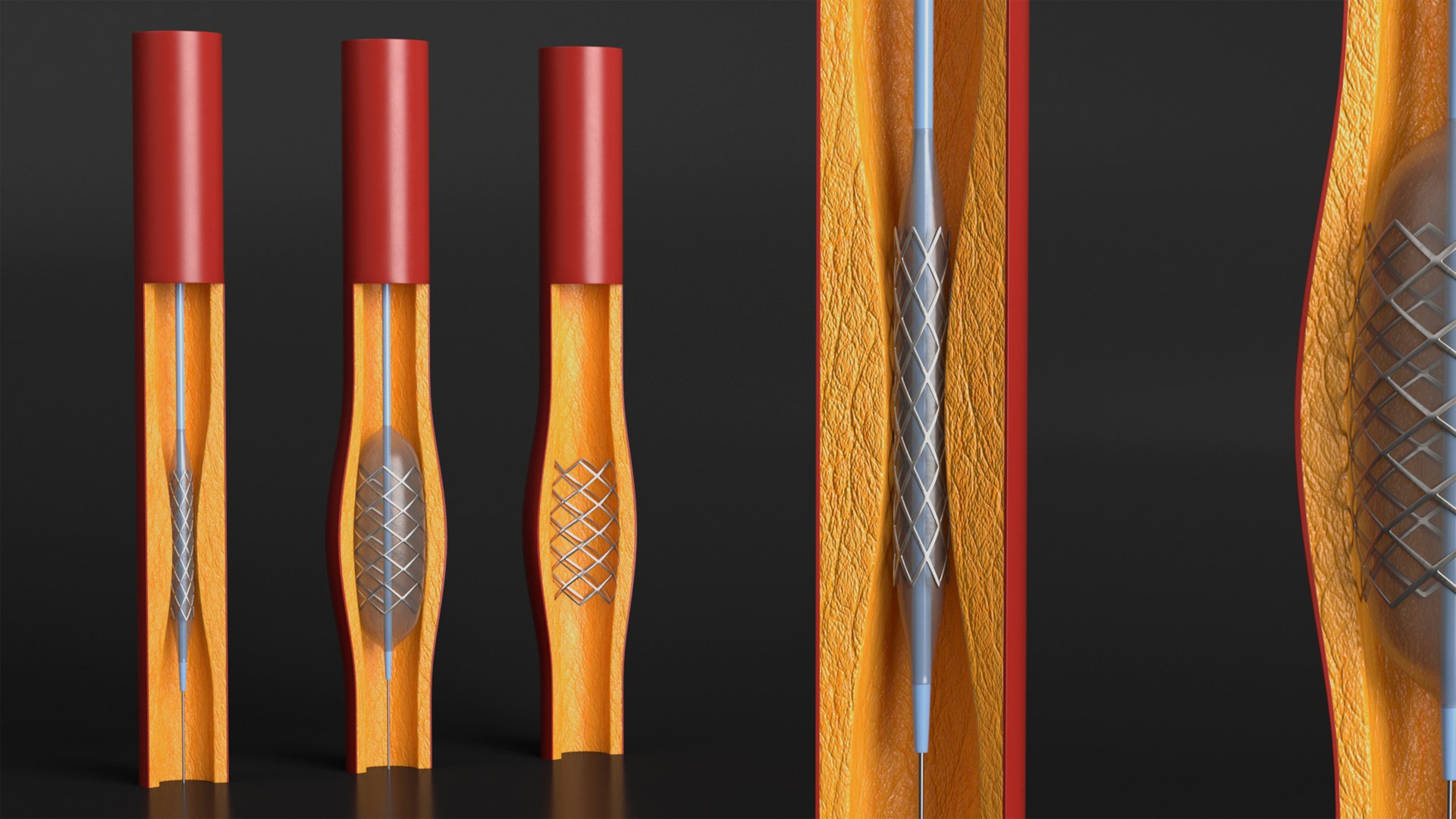Plastic Models Of Stents With Artery 3D Model - TurboSquid 2239722